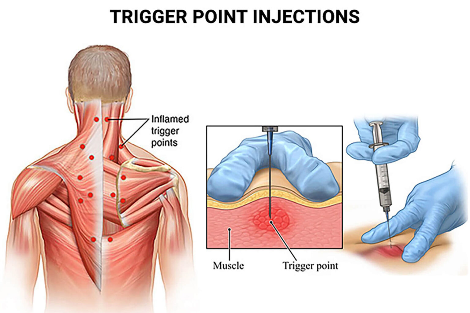 Trigger Point Therapy - Cosmo Health Resolution